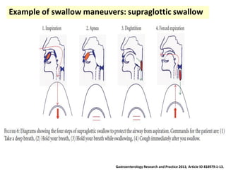 Supraglottic Swallow