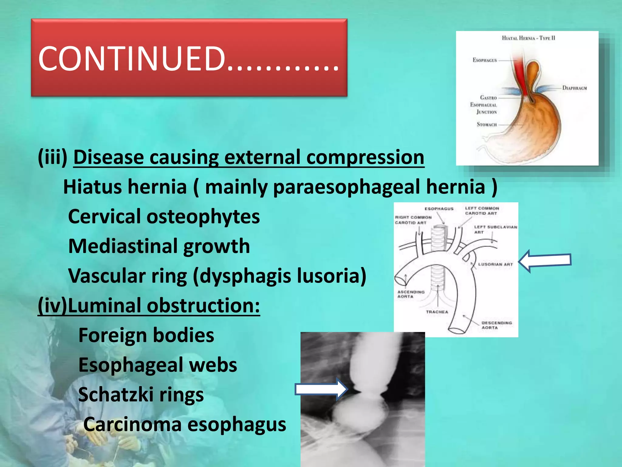 Dysphagia | PPTX