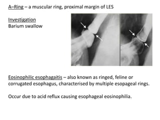 Dysphagia – non malignant causes | PPTX