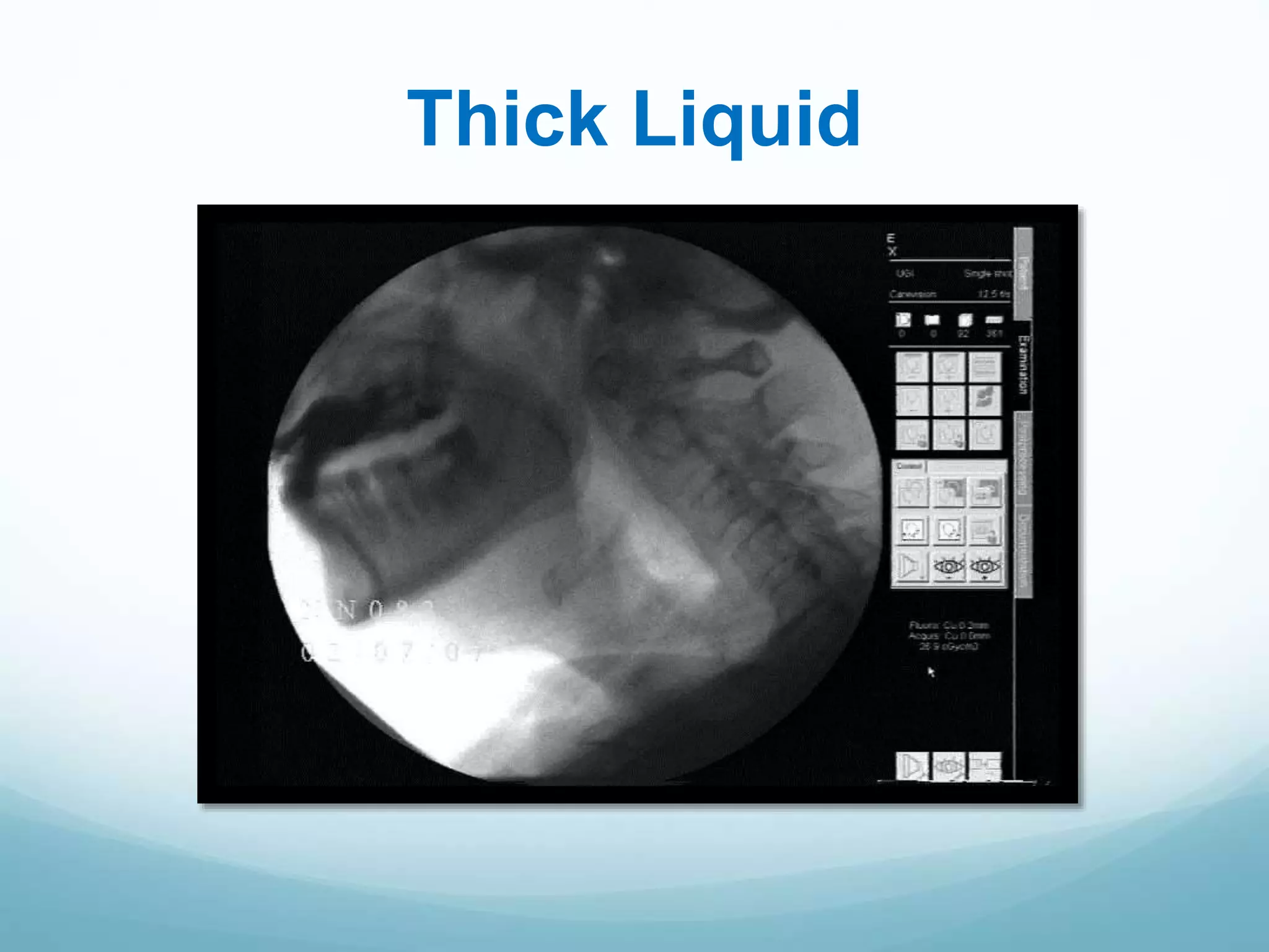 Dysphagia PowerPoint.pptx