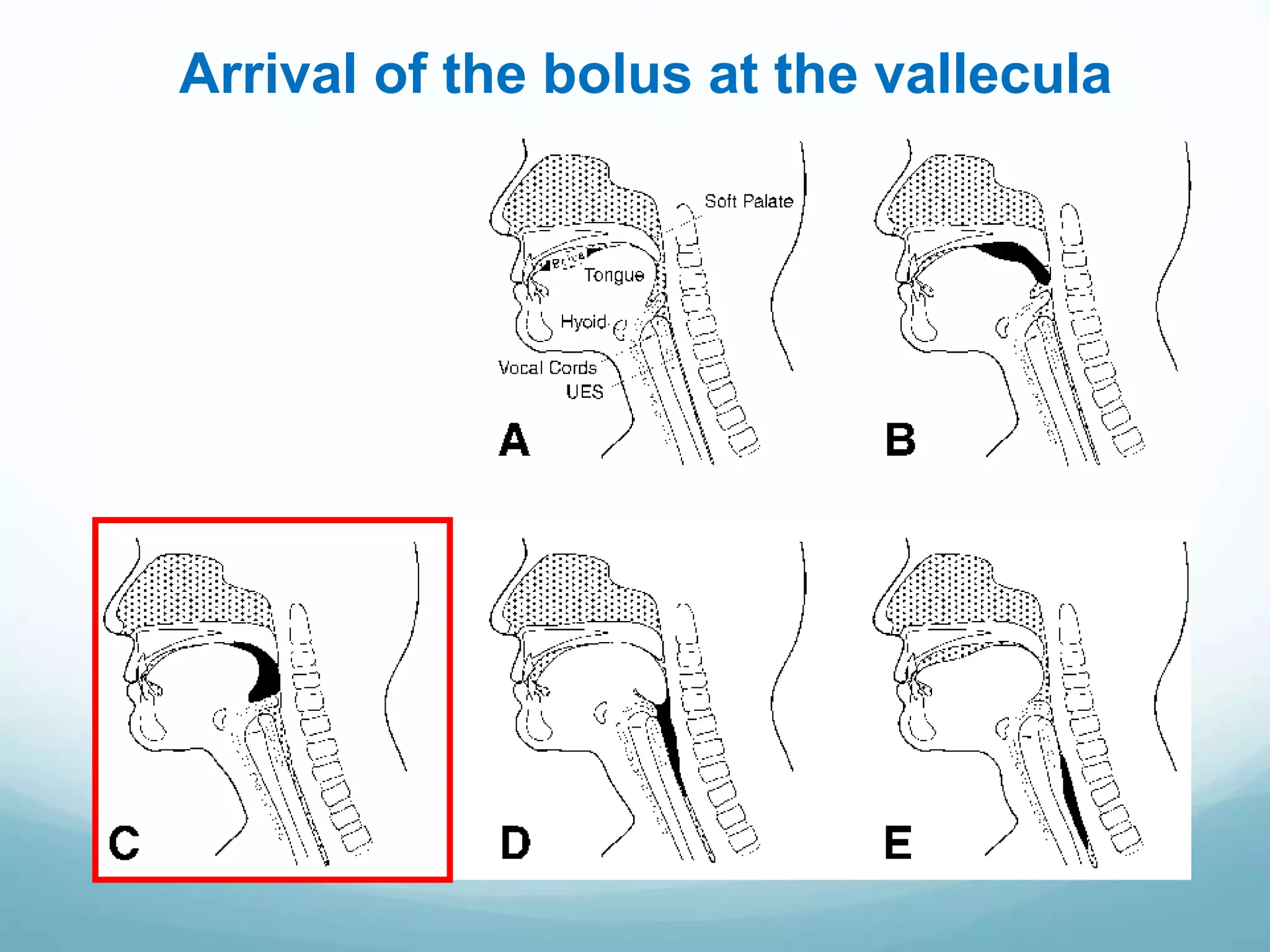 Dysphagia PowerPoint.pptx