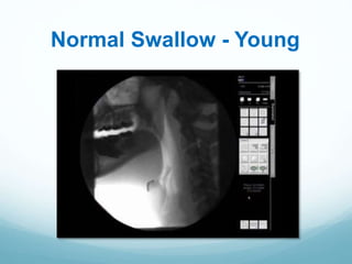 Dysphagia PowerPoint.pptx