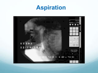 Dysphagia PowerPoint.pptx
