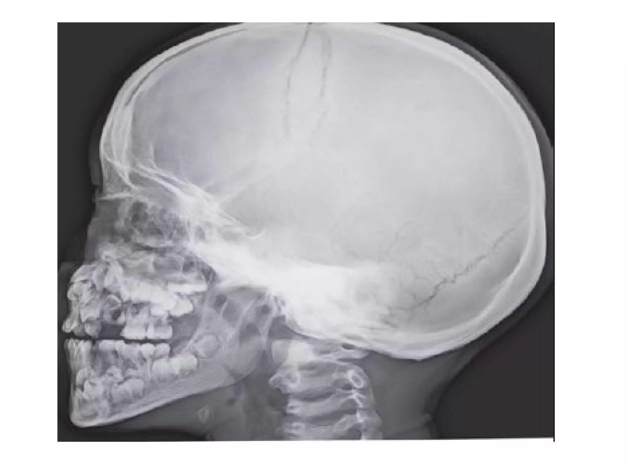 Diagnostic Imaging of Bone Dysplasia | PPT