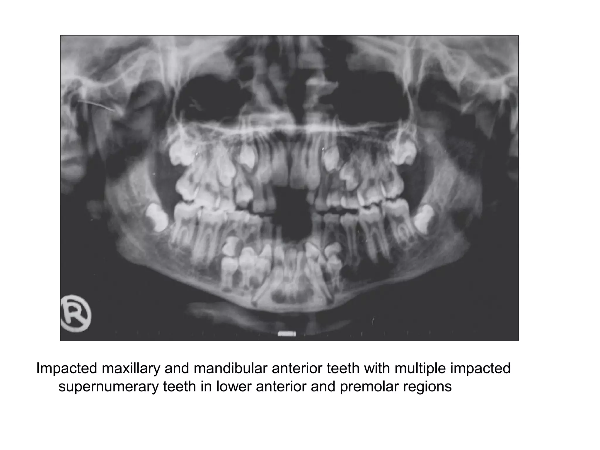 Diagnostic Imaging of Bone Dysplasia | PPT