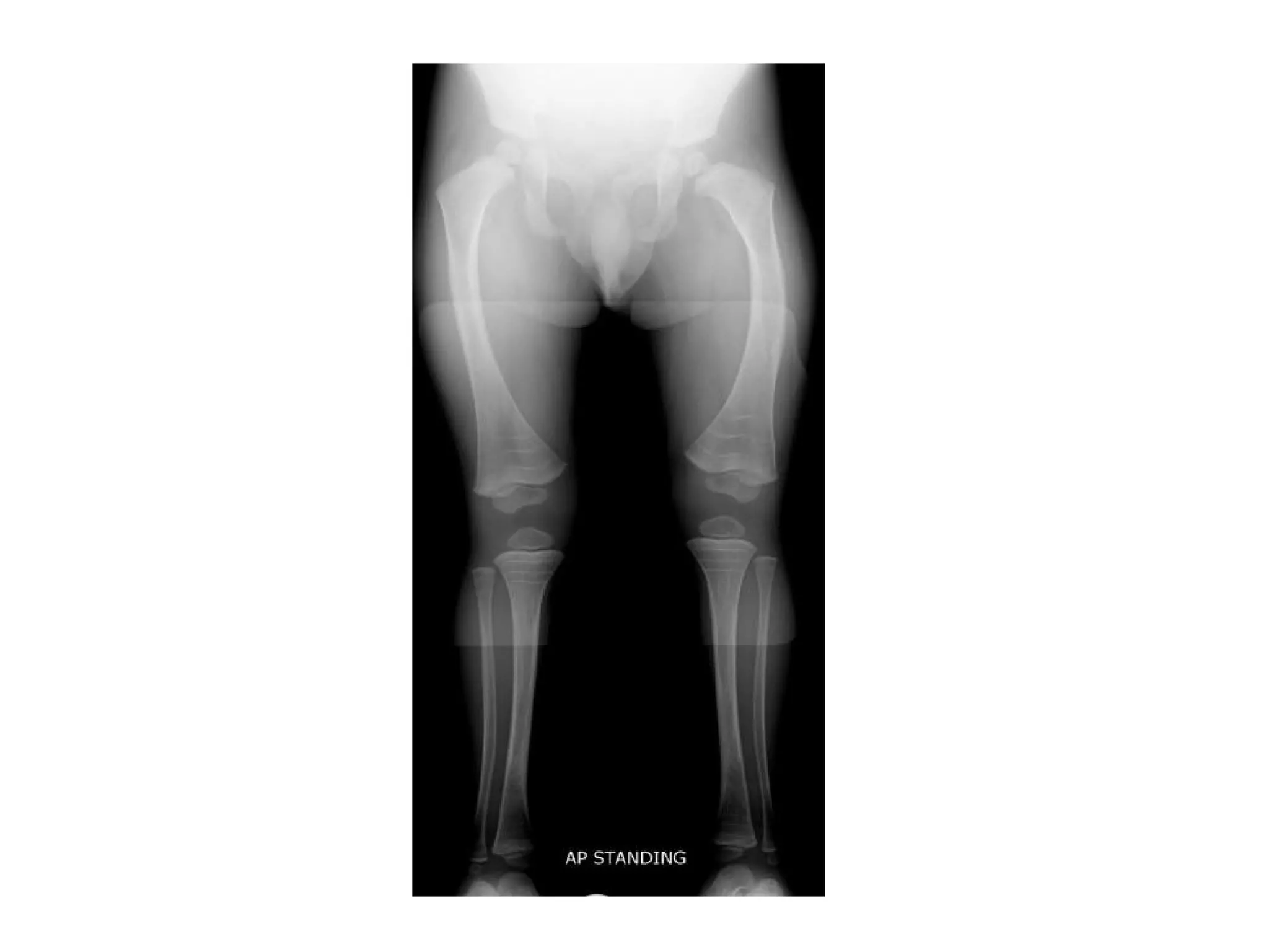 Diagnostic Imaging of Bone Dysplasia | PPT