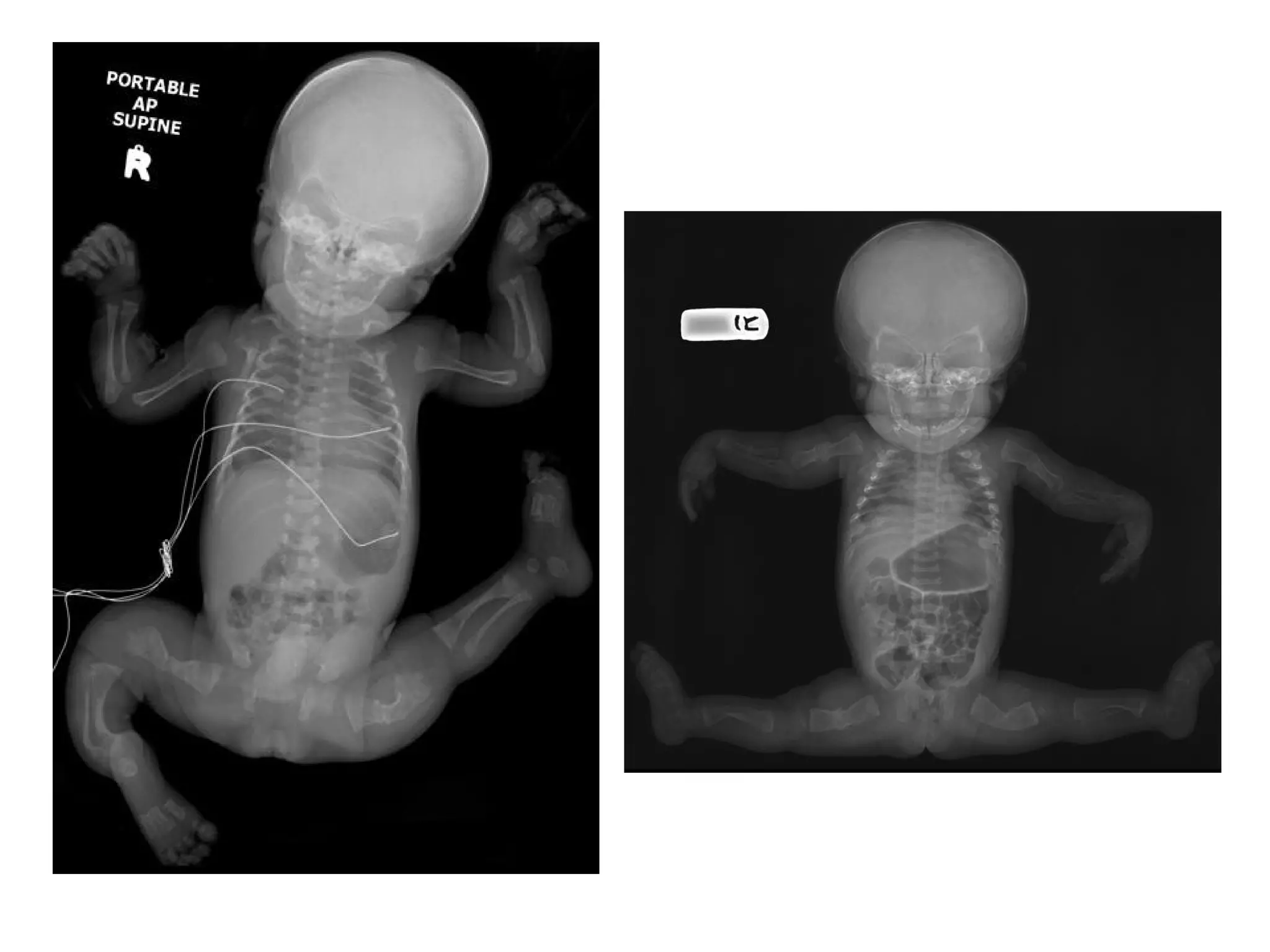 Diagnostic Imaging of Bone Dysplasia | PPT