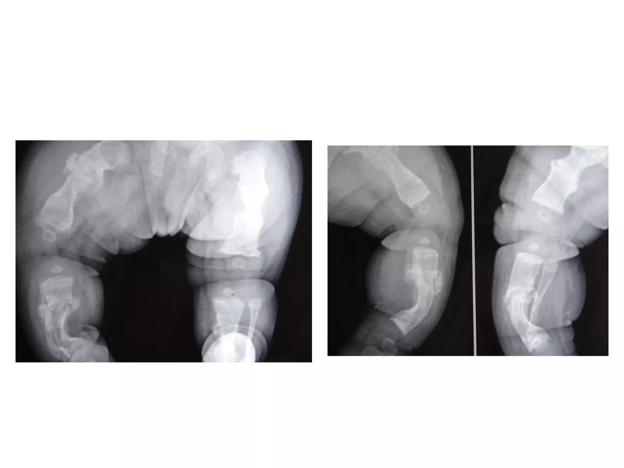 Diagnostic Imaging of Bone Dysplasia | PPT