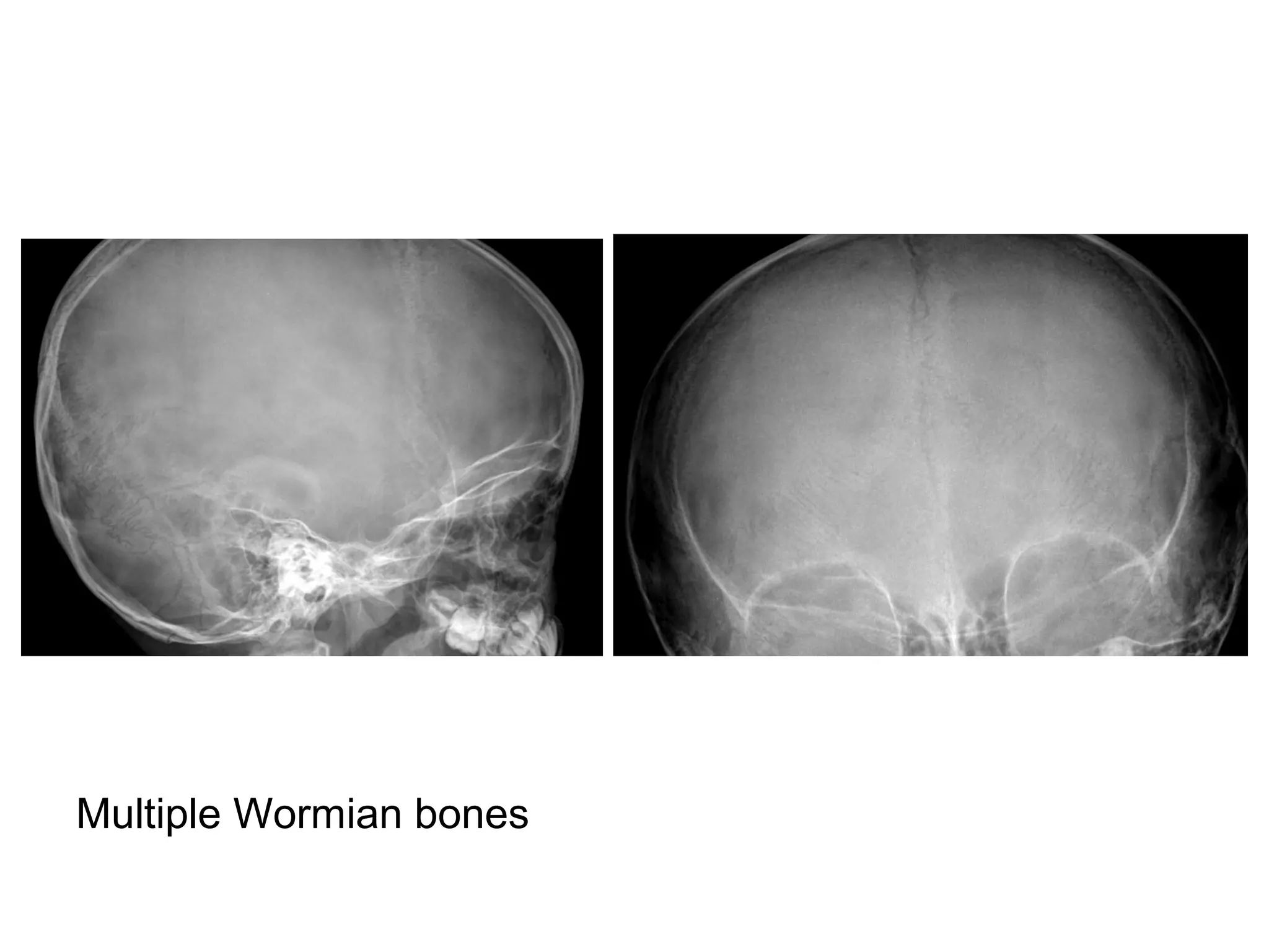 Diagnostic Imaging of Bone Dysplasia | PPT