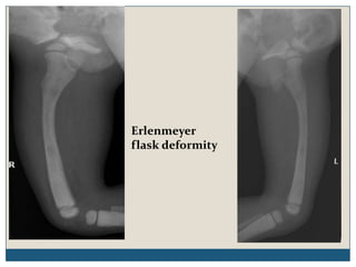 Erlenmeyer Flask Deformity