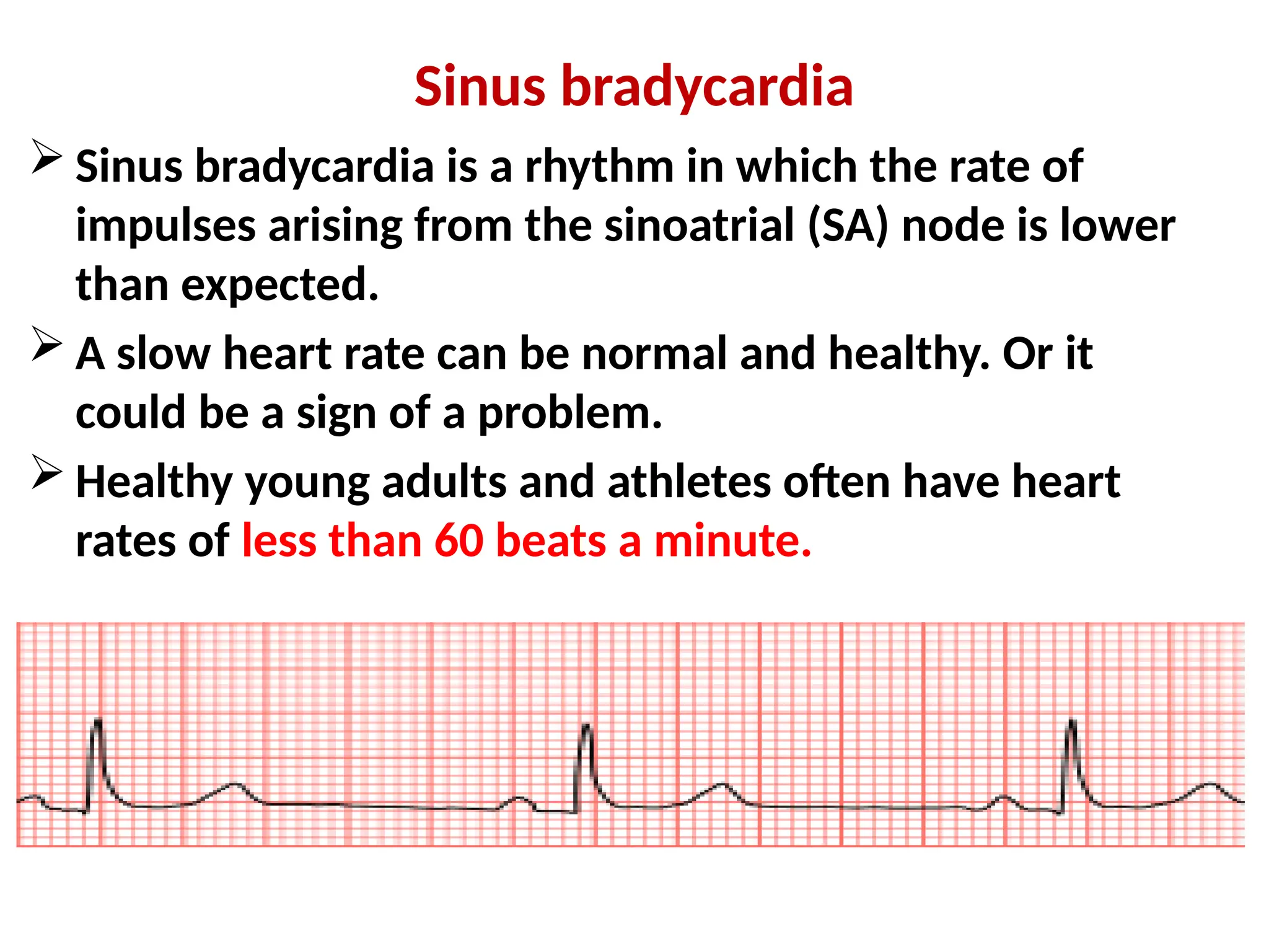 lecture on Dysrhythmias of Sino-atrial Node | PPT