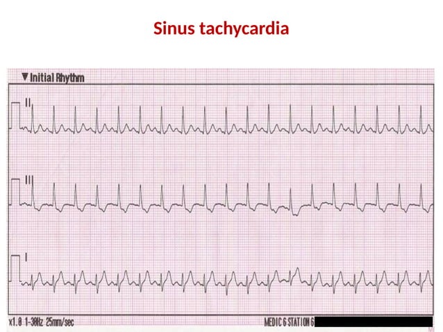 lecture on Dysrhythmias of Sino-atrial Node | PPT