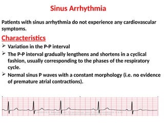 lecture on Dysrhythmias of Sino-atrial Node | PPT