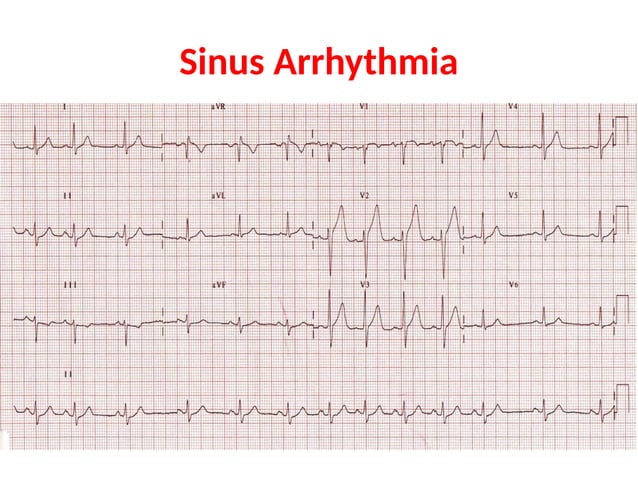 lecture on Dysrhythmias of Sino-atrial Node | PPT
