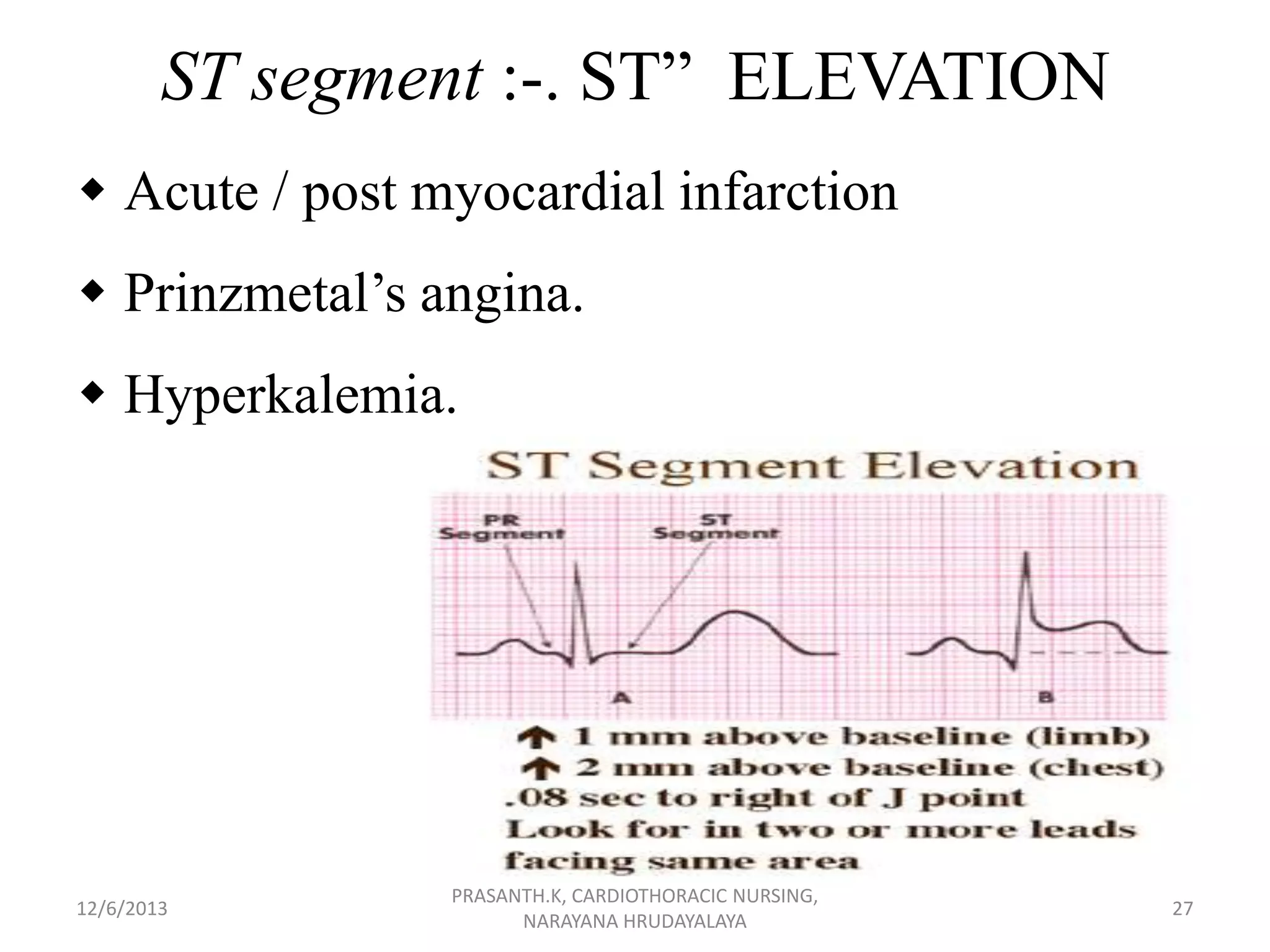 Dysrrhythmia, major arrhythmias and management, bascs of ECG. | PPSX