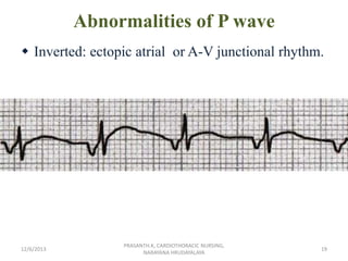 Dysrrhythmia, major arrhythmias and management, bascs of ECG. | PPSX