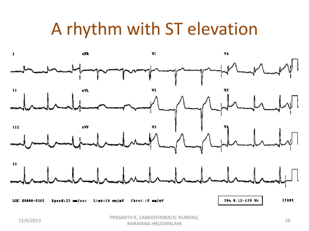 Dysrrhythmia, major arrhythmias and management, bascs of ECG. | PPSX