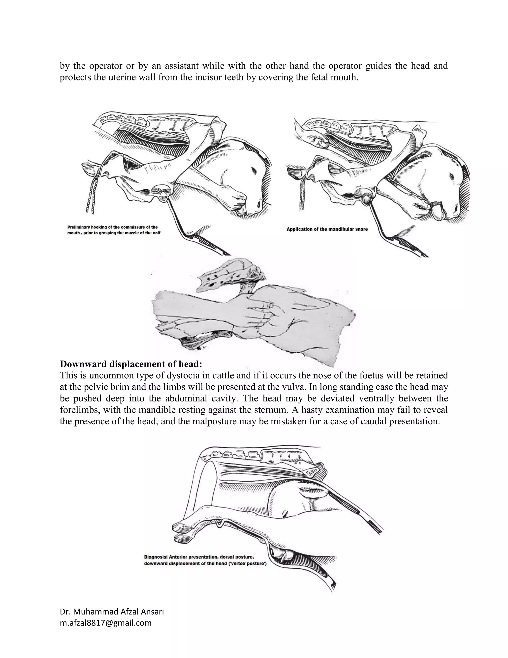 Dystocia due to faulty position, presentation and posture and their ...