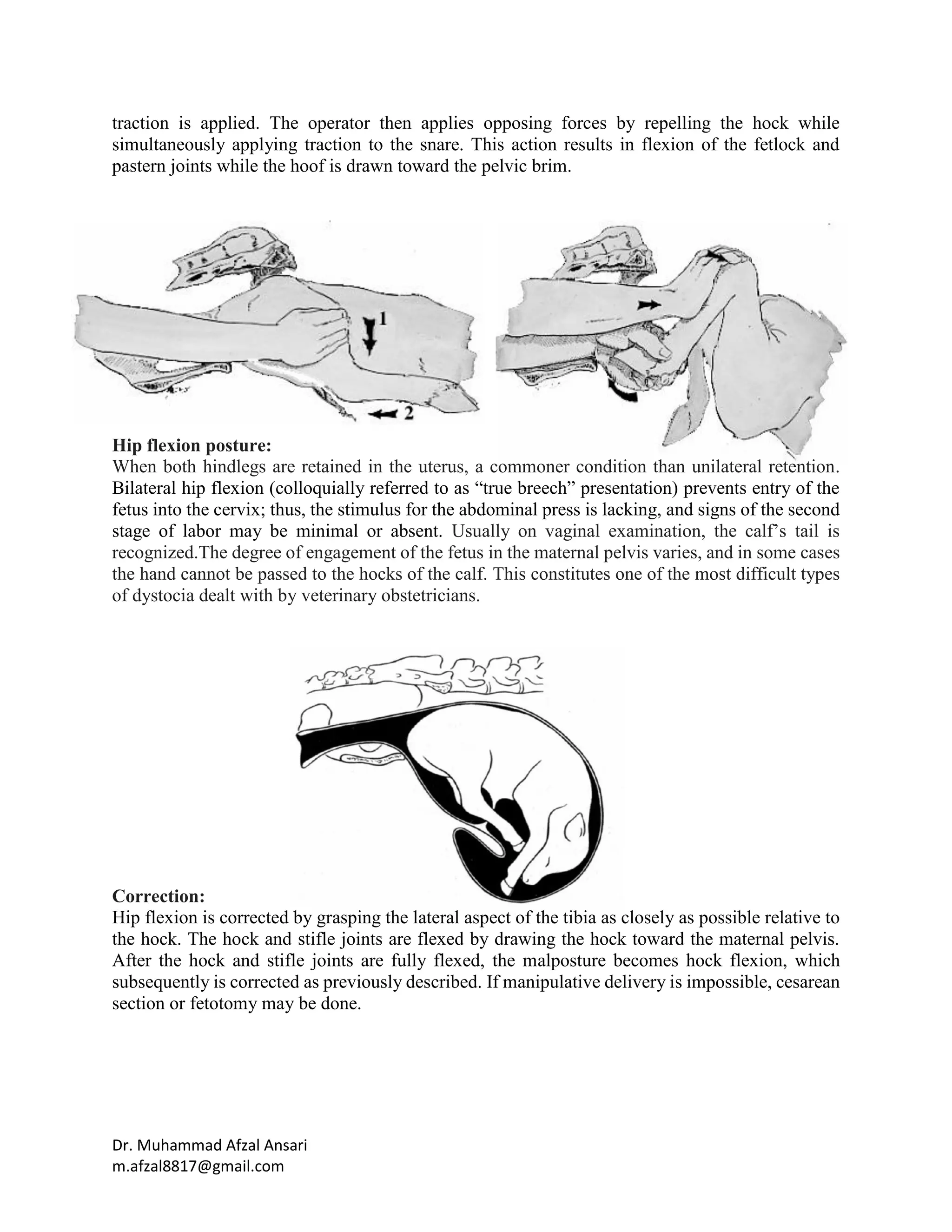 Dystocia due to faulty position, presentation and posture and their ...