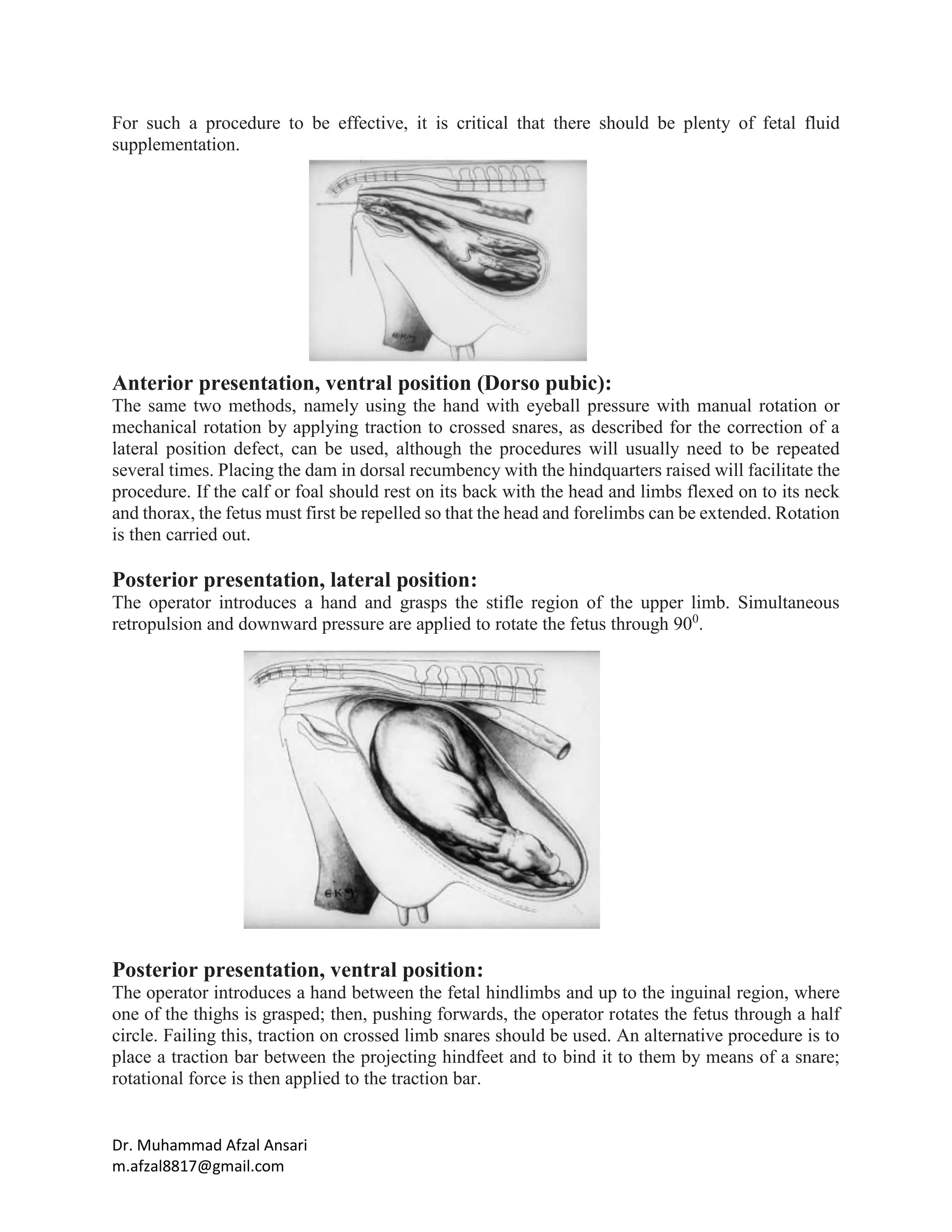 Dystocia due to faulty position, presentation and posture and their ...