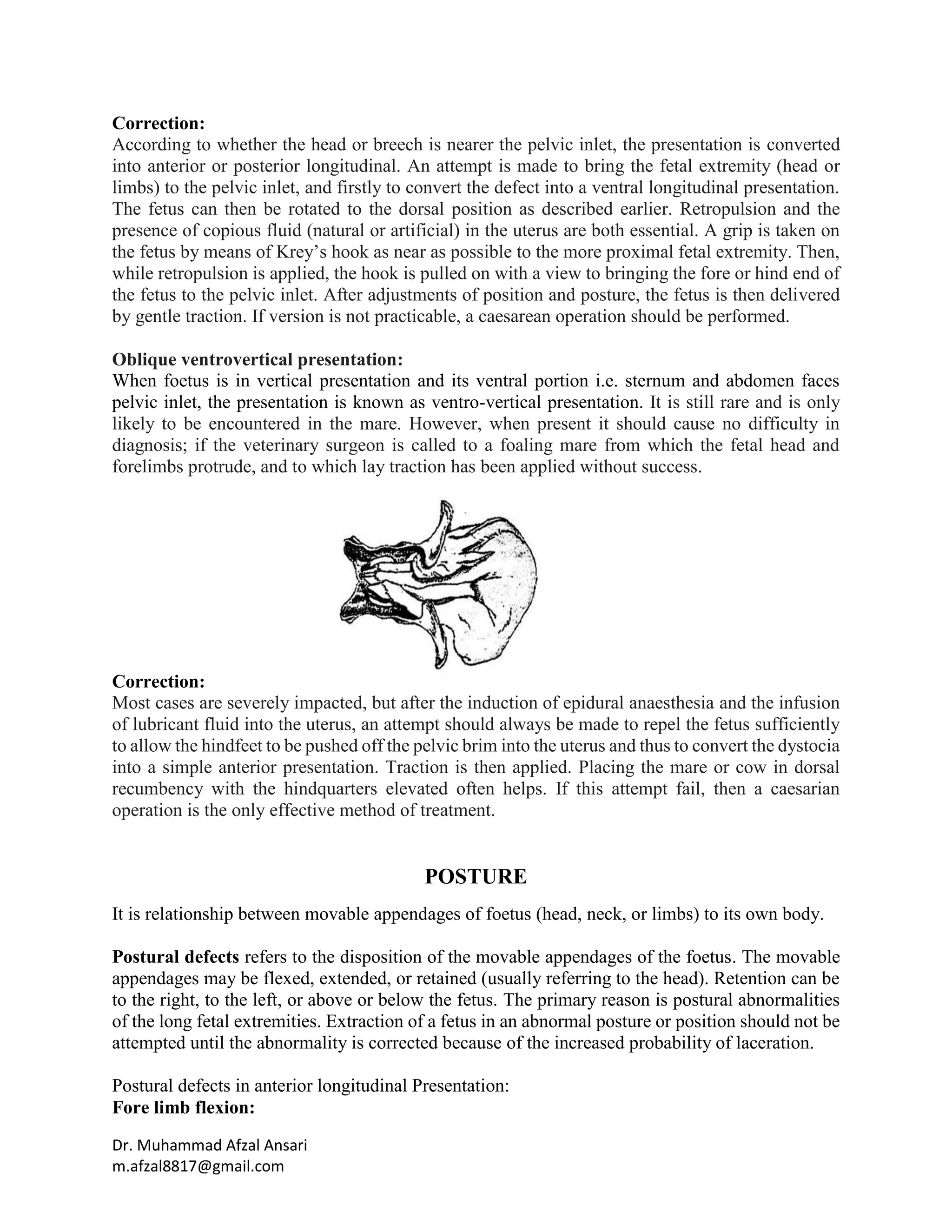 Dystocia due to faulty position, presentation and posture and their ...