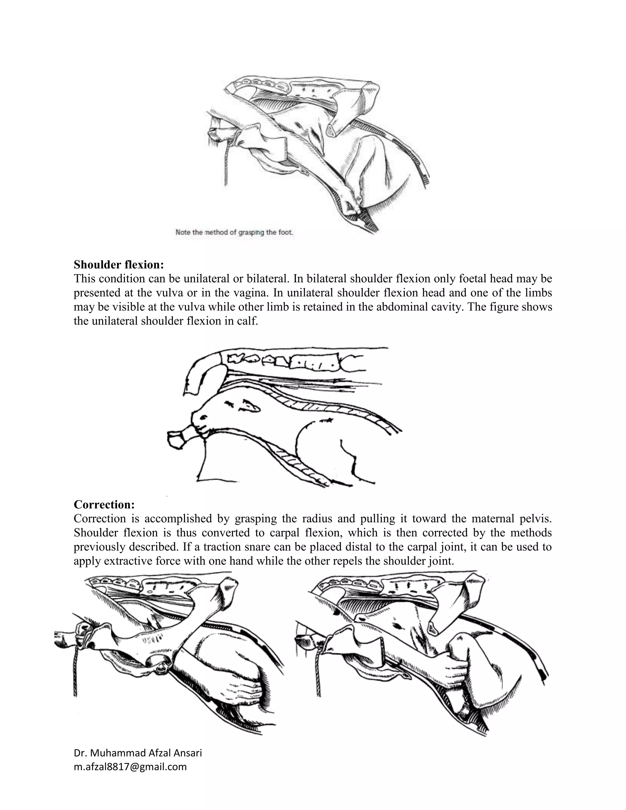 Dystocia due to faulty position, presentation and posture and their ...