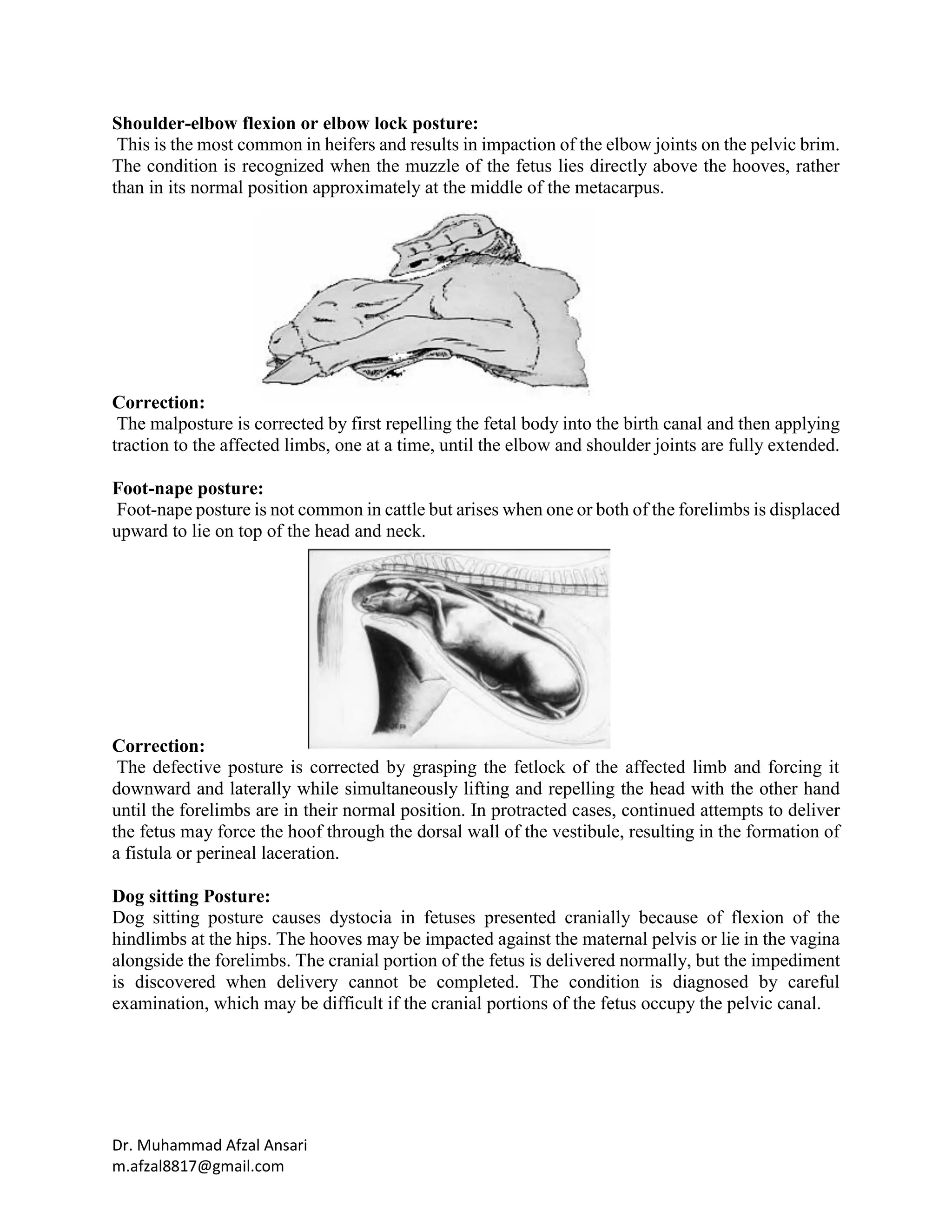 Dystocia due to faulty position, presentation and posture and their ...