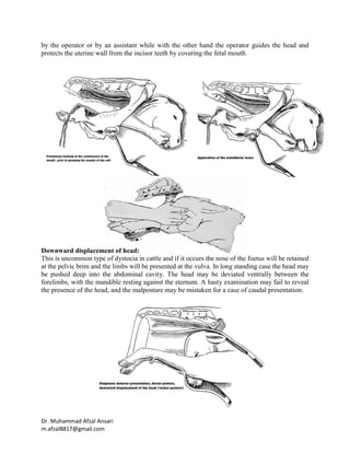 Dystocia due to faulty position, presentation and posture and their ...