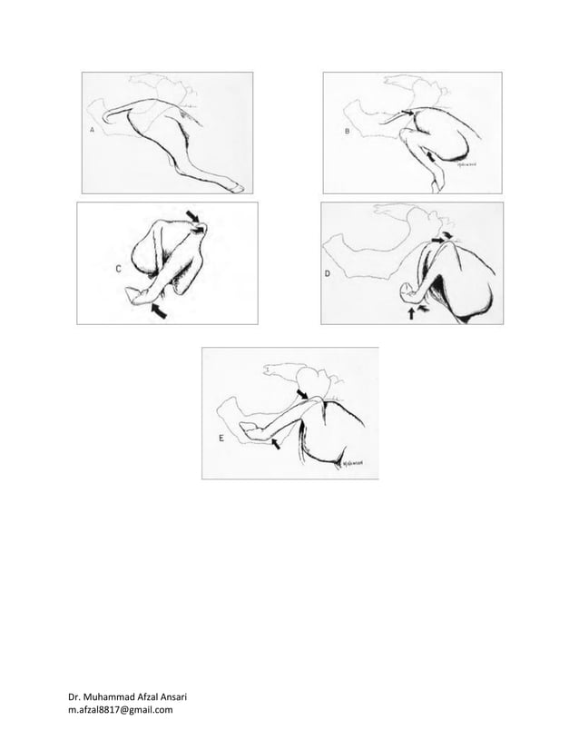 Dystocia due to faulty position, presentation and posture and their ...