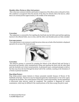 Dystocia due to faulty position, presentation and posture and their ...