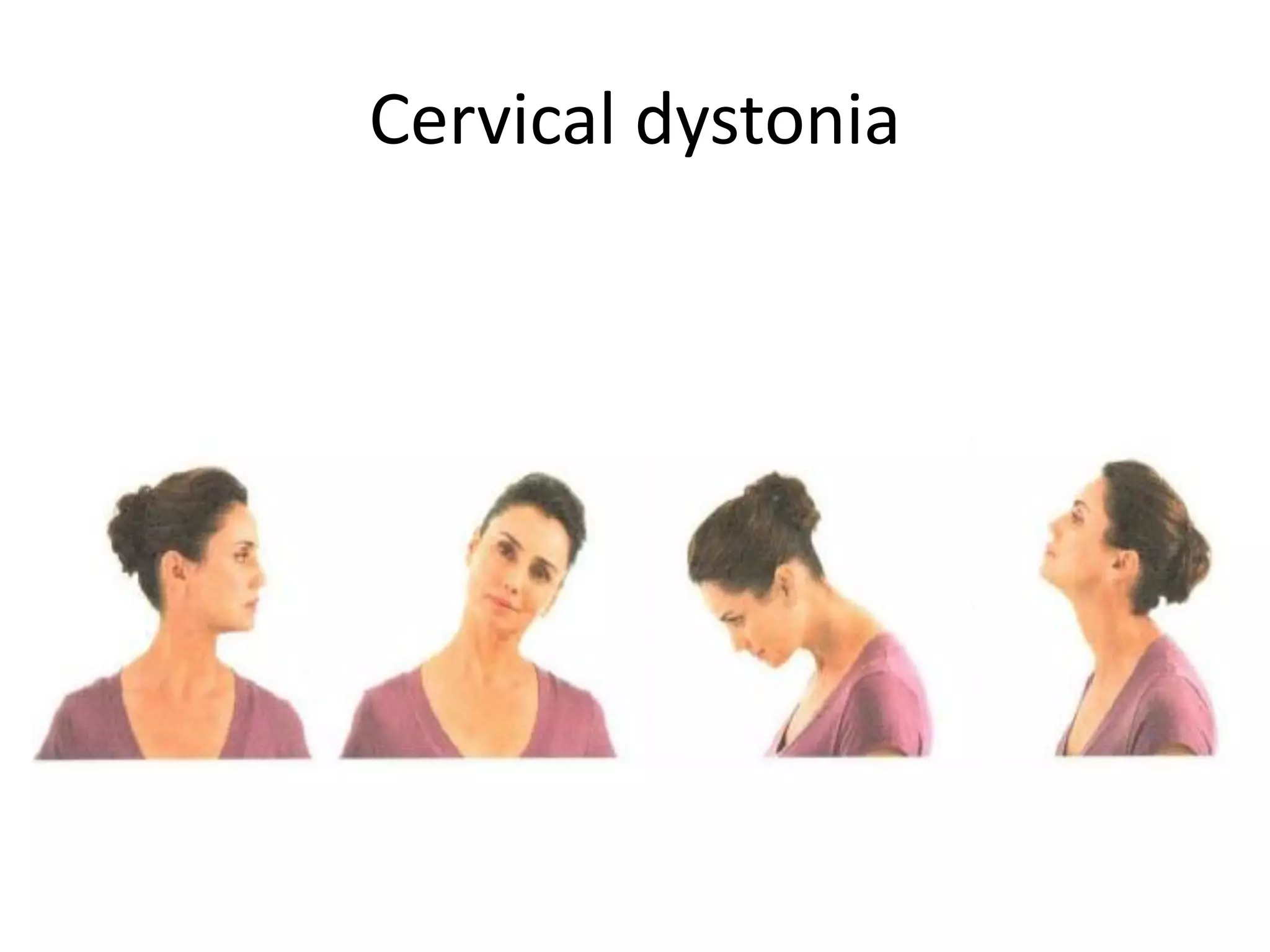 Dystonia | PDF