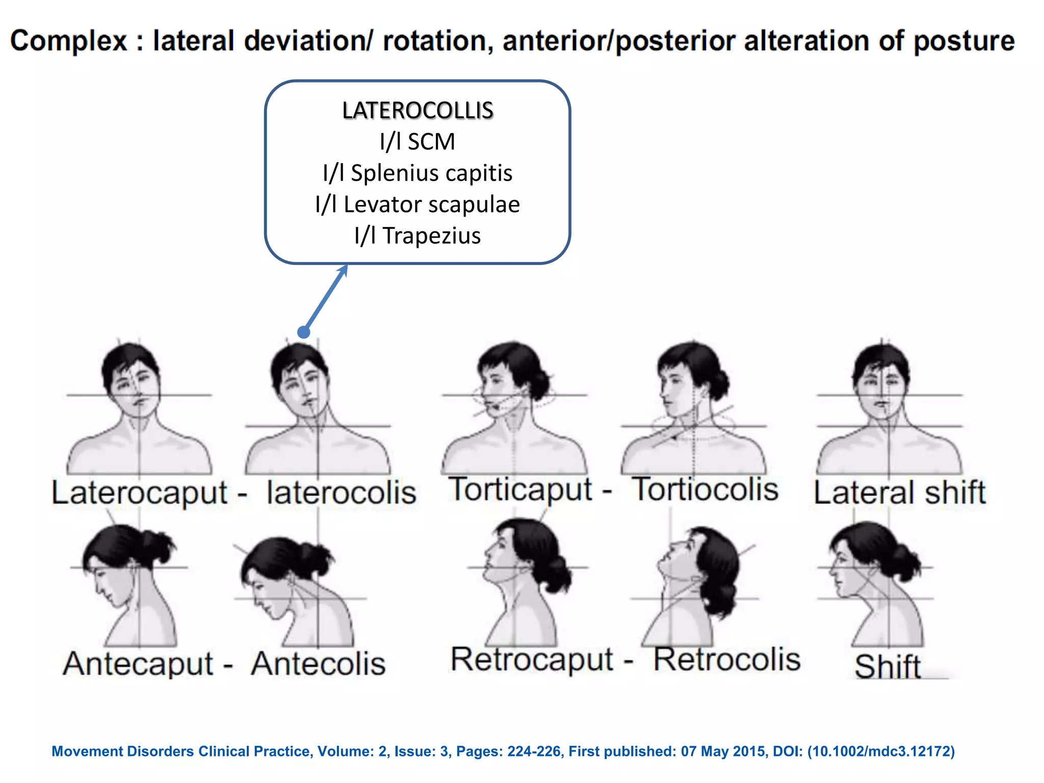 Dystonia | PPTX