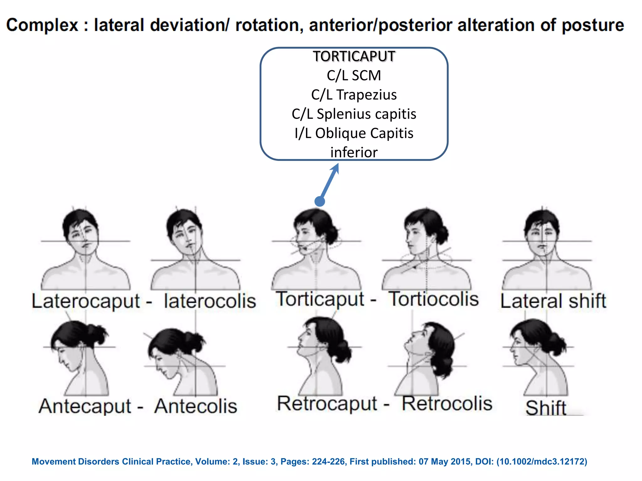 Dystonia | PPTX