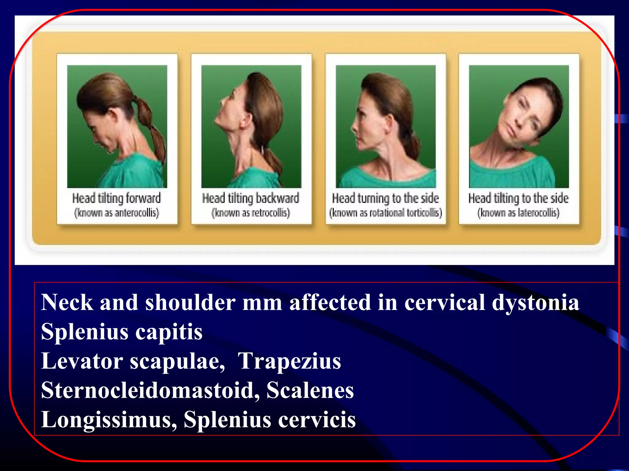 Dystonia | PPT