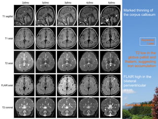 Mucolipidosis type4 case report | PPTX