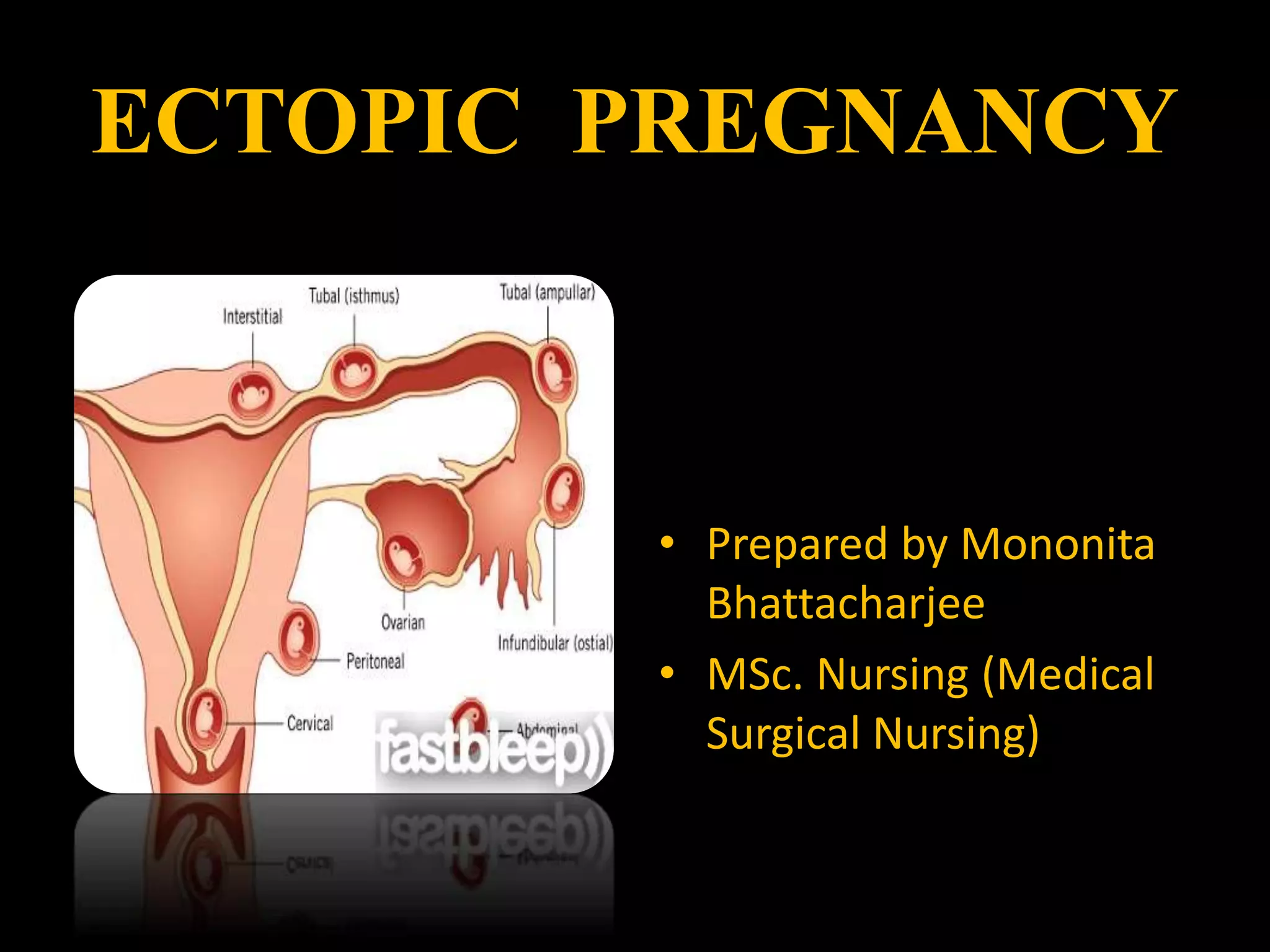 Ectopic Pregnancy | PPTX