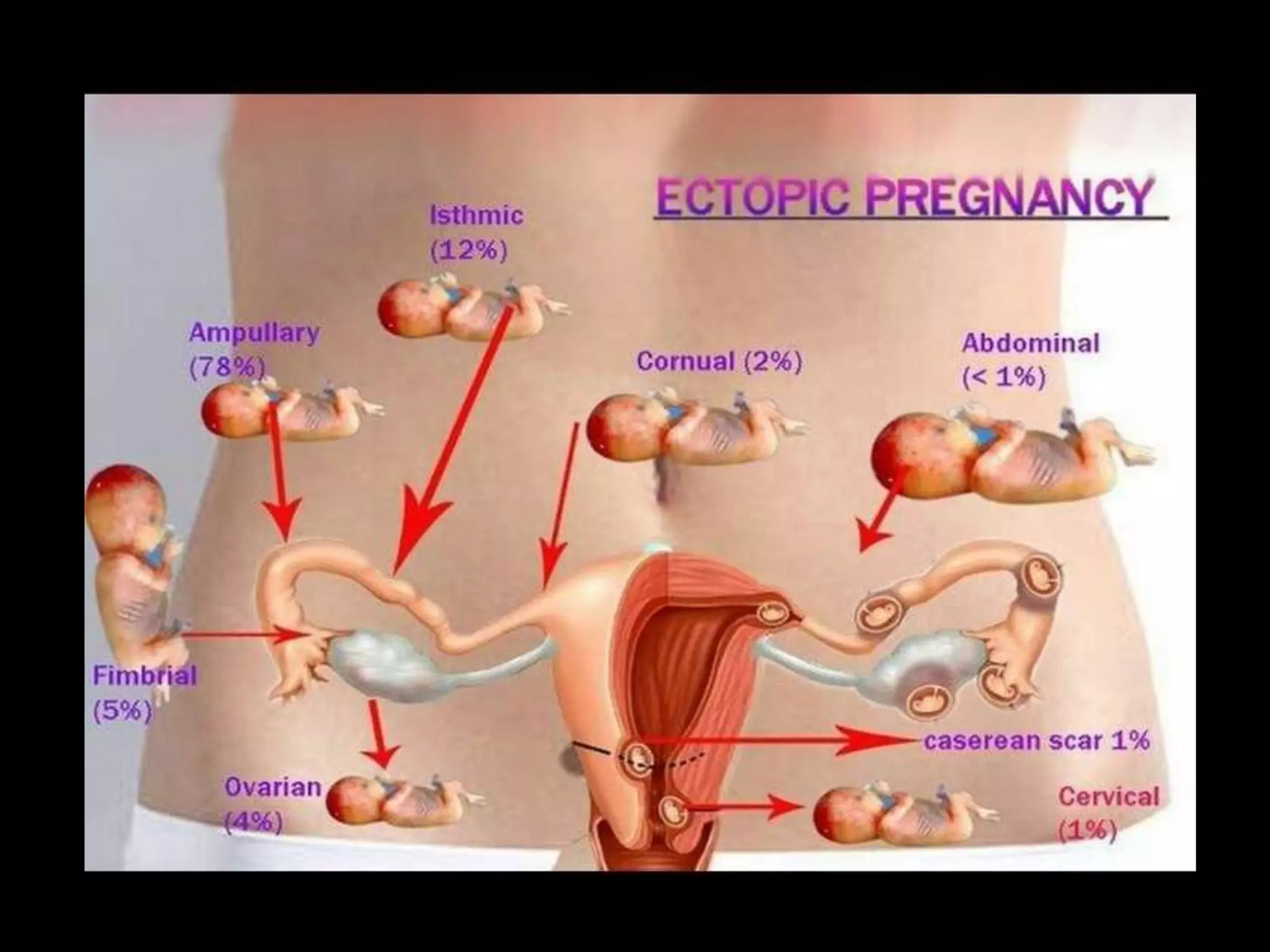 Ectopic Pregnancy | PPTX
