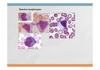Atypical Lymphocyte Vs Monocyte