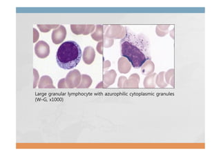 Atypical Lymphocytes With Azurophilic Granules