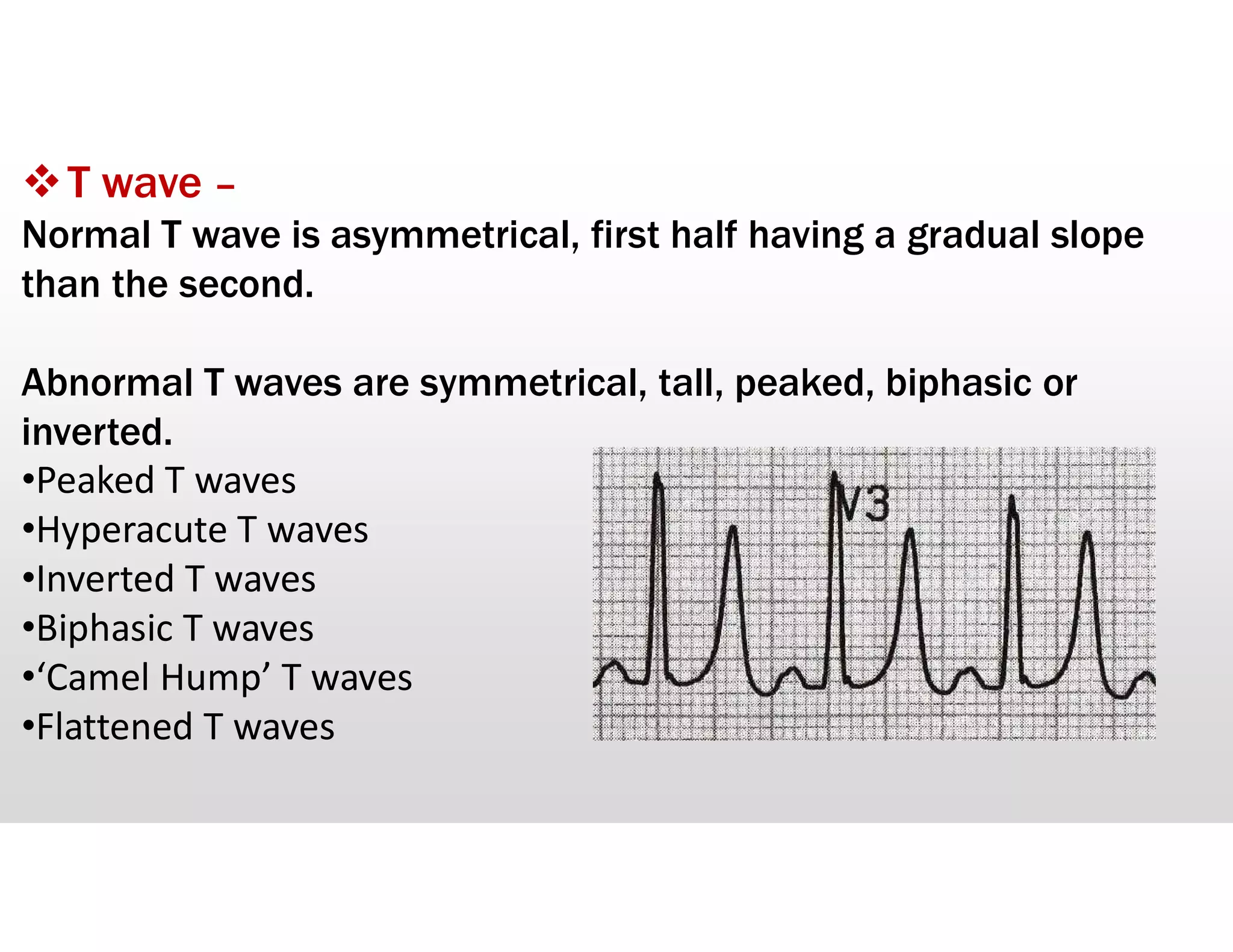 E.C.G. UNDERSTANDING AND INTERPRETATION | PDF