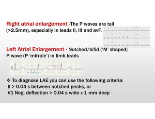 E.C.G. UNDERSTANDING AND INTERPRETATION | PDF