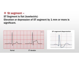 E.C.G. UNDERSTANDING AND INTERPRETATION | PDF