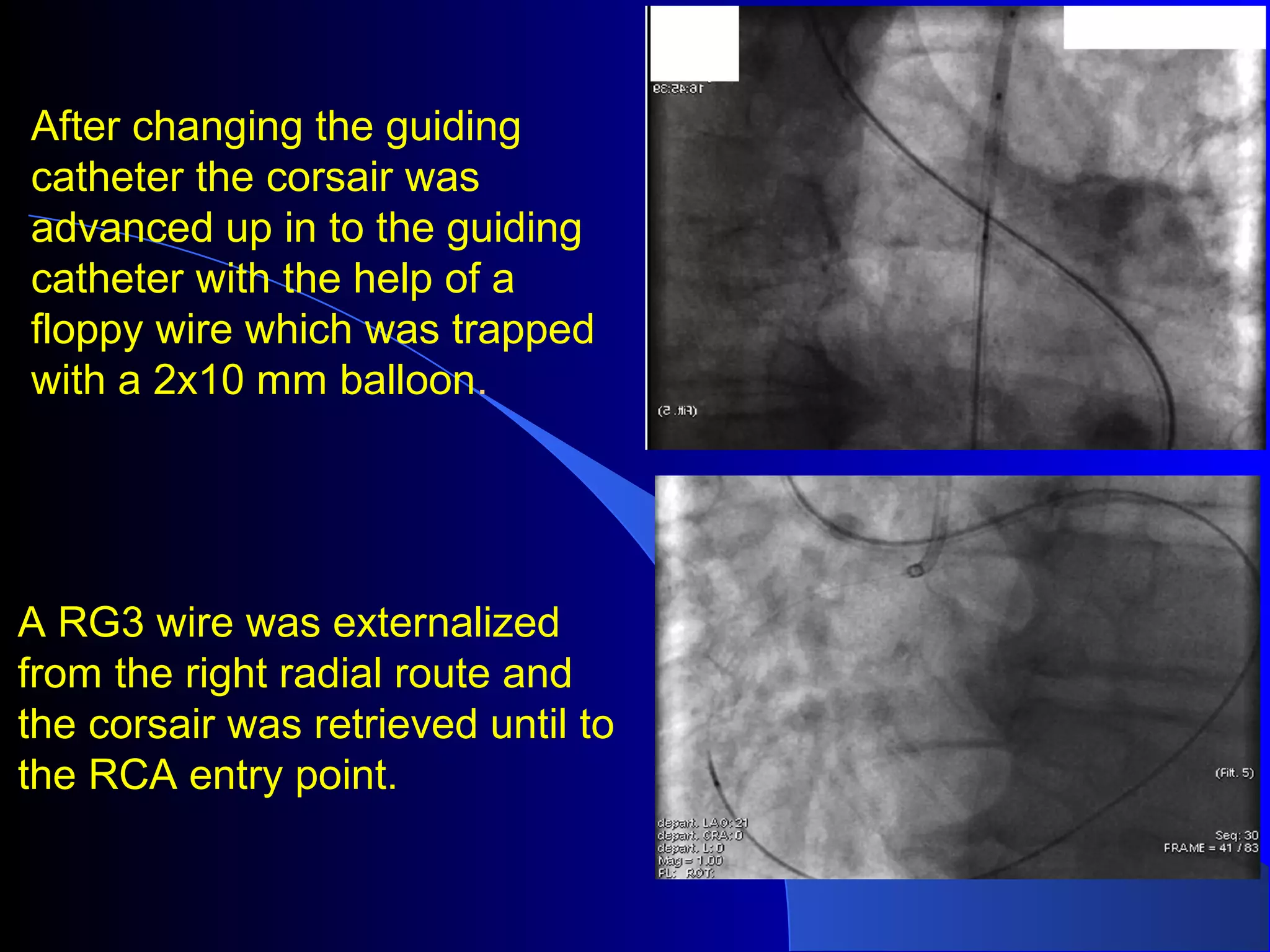 E-case03 Gorgulu aimradial20170921 Bi-radial approach CTO | PPT