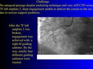 E-case03 Gorgulu aimradial20170921 Bi-radial approach CTO | PPT