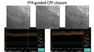 E-poster06 Rusza aimradial20170921 Coronary artery fistula | PPT
