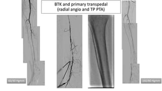 E-poster12 Ruzsa aimradial20170922 Retrograde transpedal | PPT