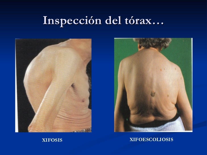 E X A M E N FÍ S I C O D E T O R A X