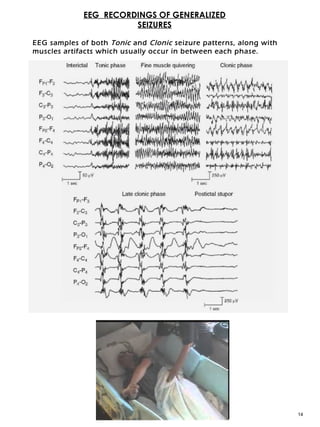 EEG & Epilepsy syndromes report [Autosaved] | PPT | Brain and Nervous ...