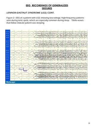 EEG & Epilepsy syndromes report [Autosaved] | PPT