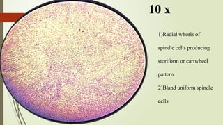 pathology dermatofibrosarcoma protuberence.pptx